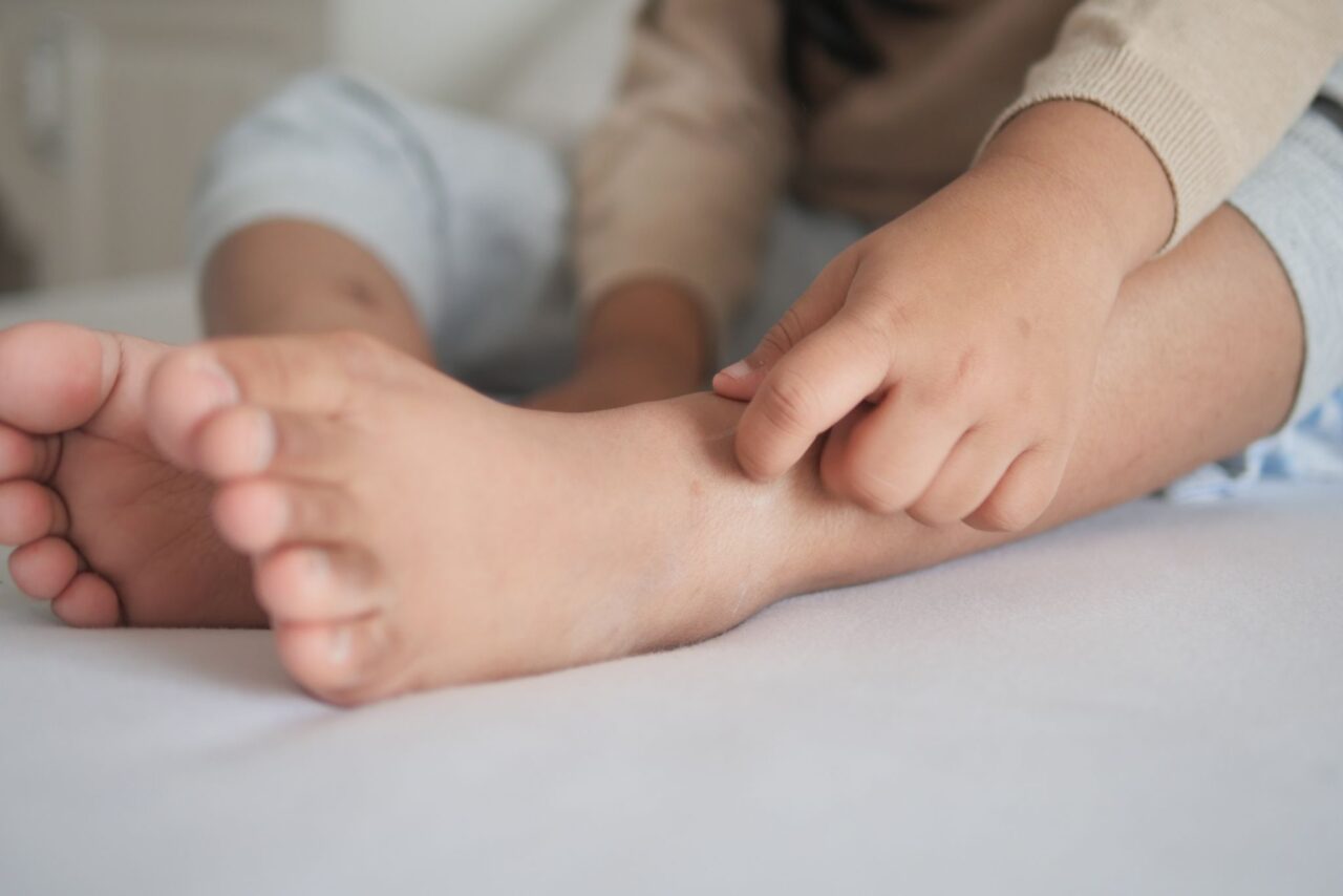 Severs Disease | Crown Foot & Ankle