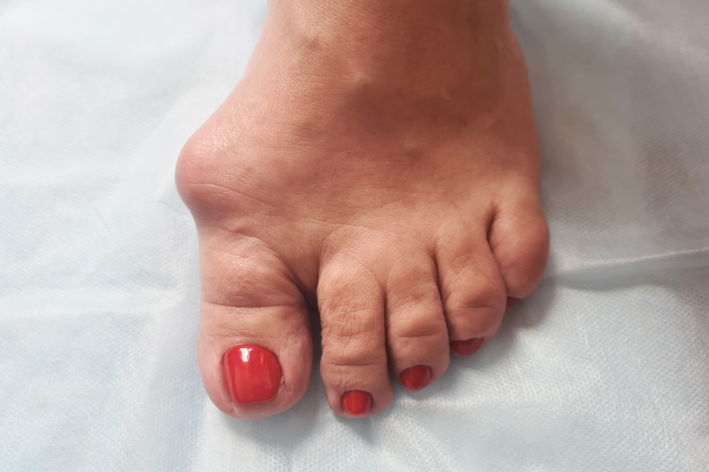 Bunions | Crown Foot & Ankle | Natasha Mandula, DPM